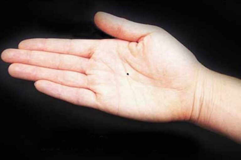 Importance Of Mole On Body And Astrology Behind Mole On Body